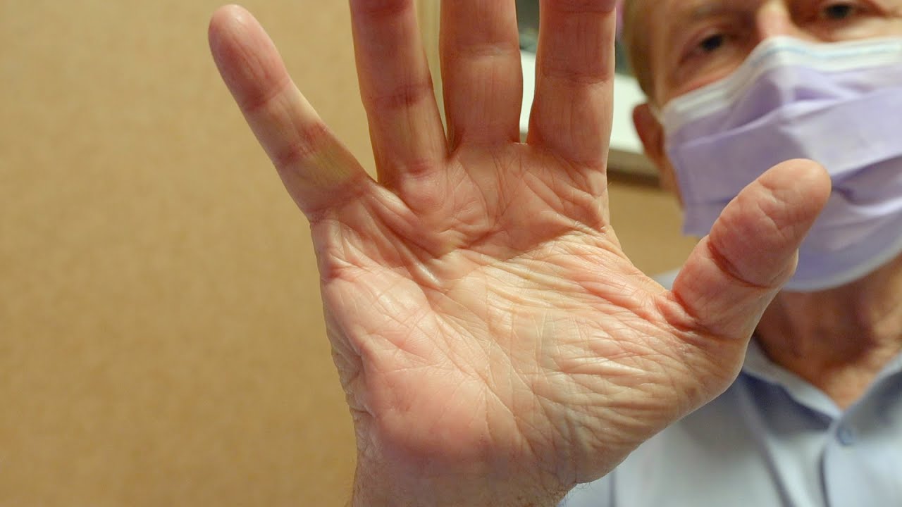 Mayo Clinic Minute Treating Dupuytren S Contracture Without Surgery