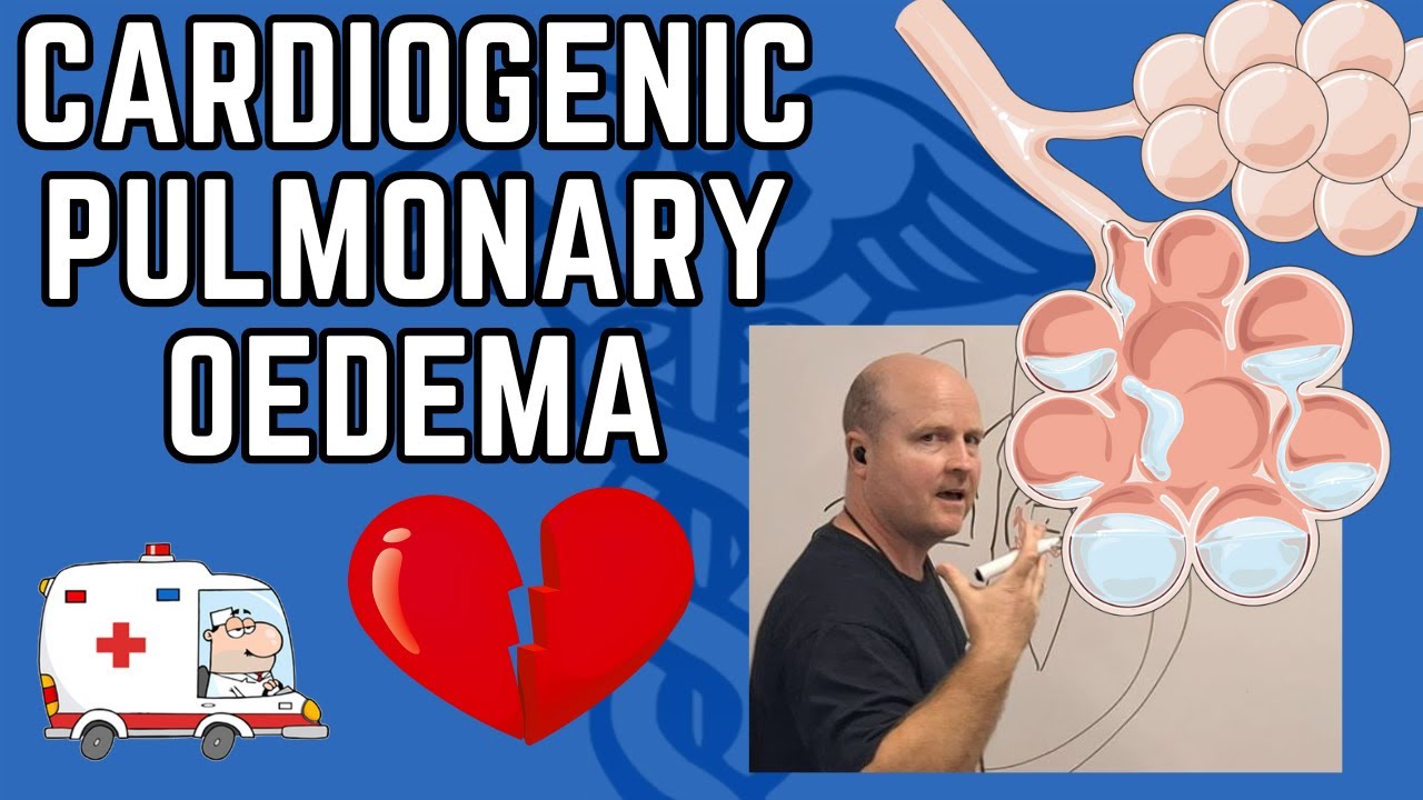 Cardiogenic Pulmonary Oedema Explained Youtube