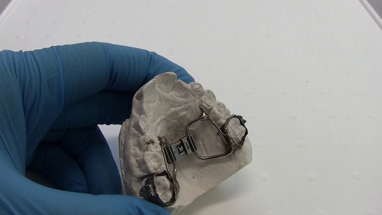 How To Turn An Expander For Braces At Benjamin Macbain Blog