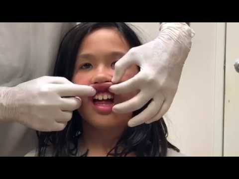 Frenectomy Lip And Tongue Exercises Tutorial Youtube