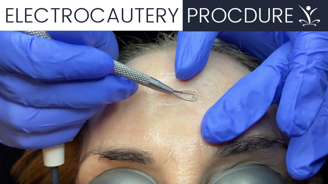 Watch An Electrocautery Procedure Youtube