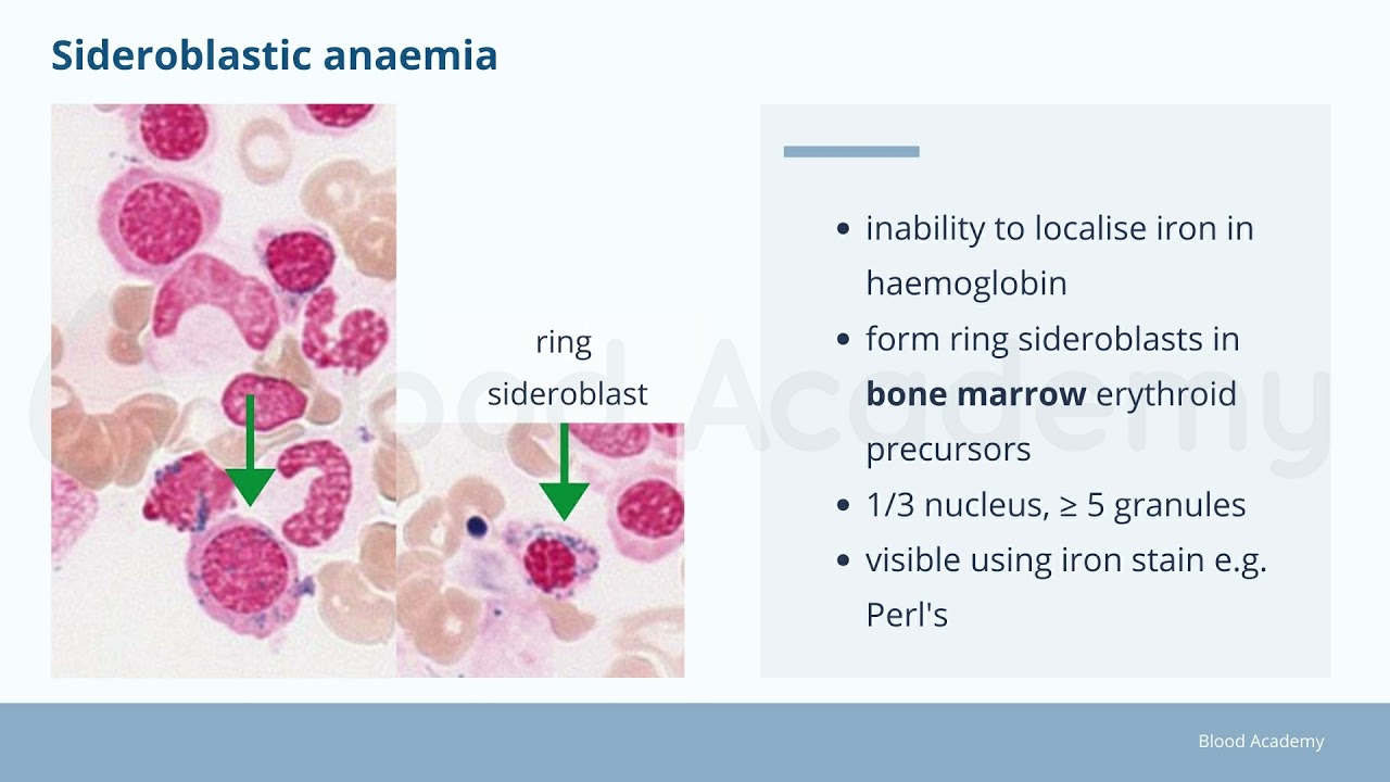 Sideroblastic Anemia Peripheral Smear