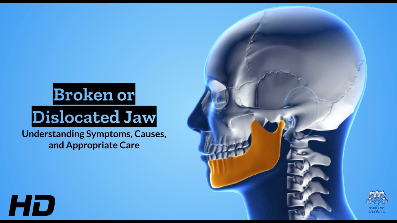 Broken Or Dislocated Jaw Mending The Misery Youtube