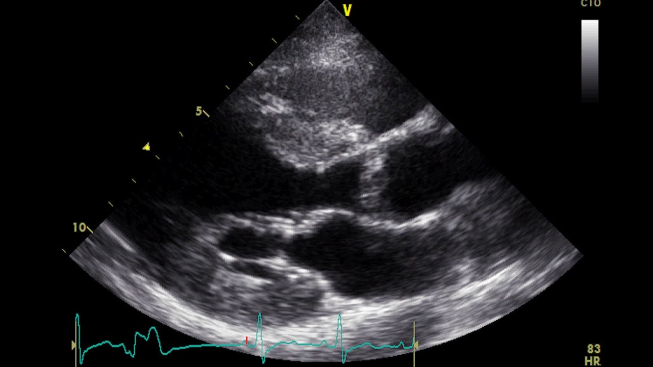 Pvc Echo Parasternal Long Axis View Aortic Stenosis Youtube