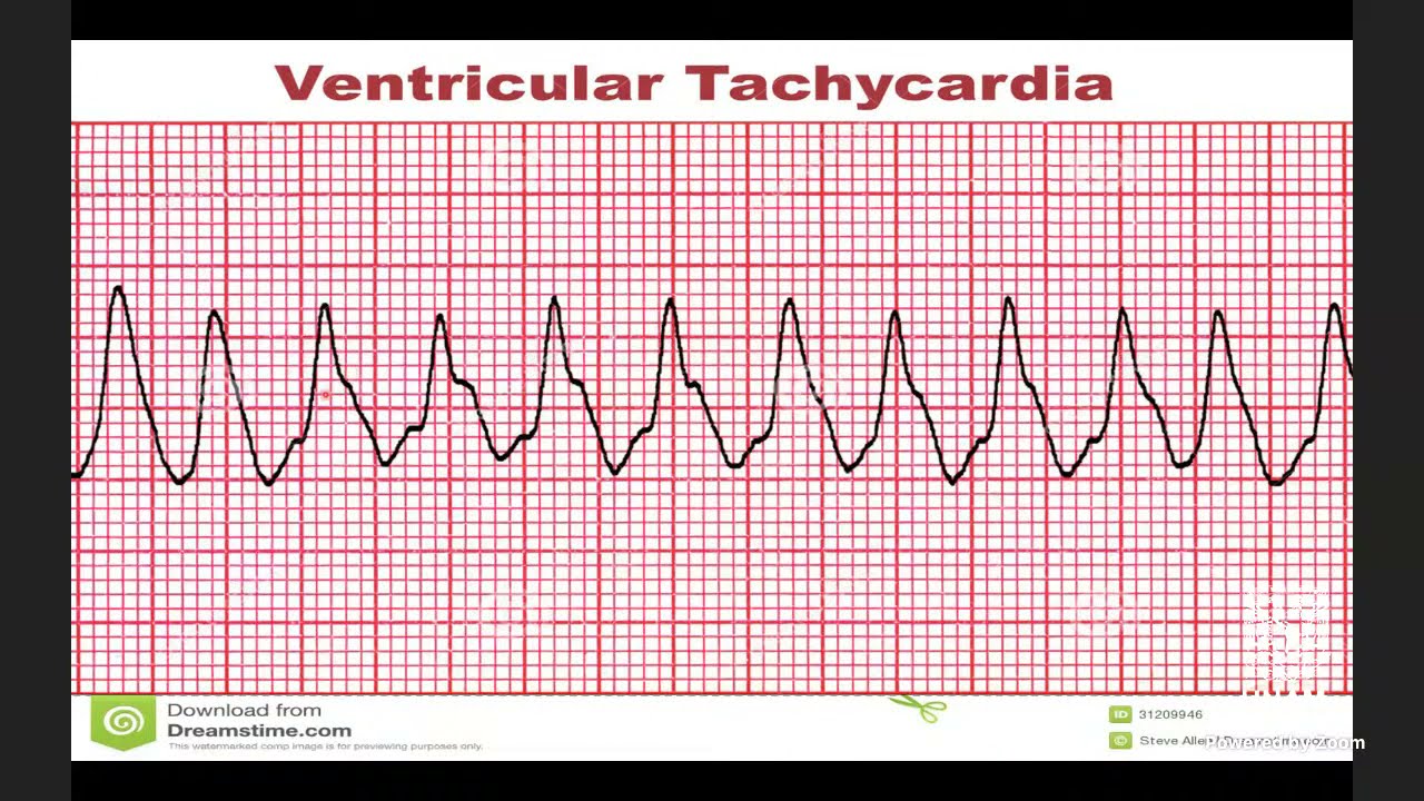 Taquicardia Supraventricular Cardioversão Elétrica Sincronizada Retoedu