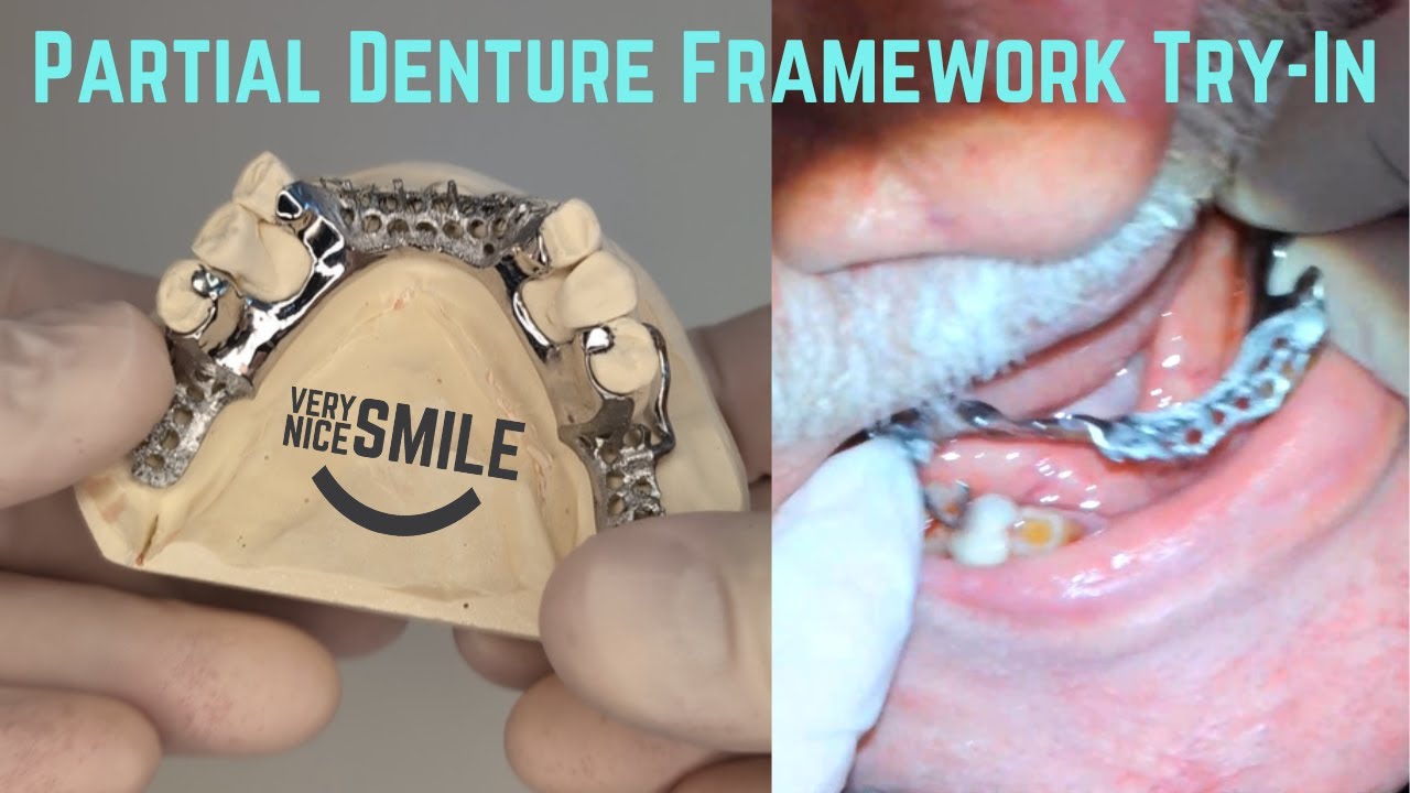Partial Denture With Metal Framework Try In Youtube