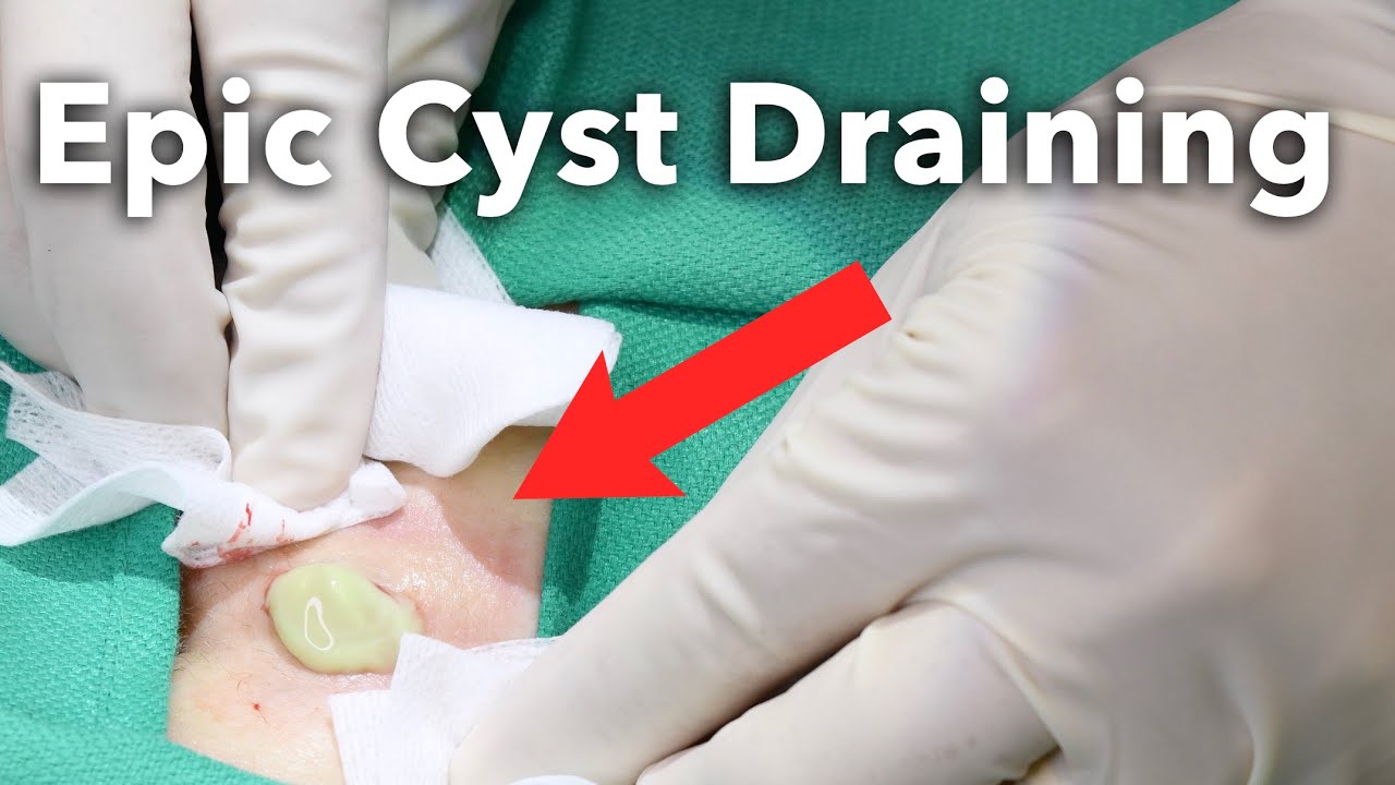 Draining A Pilonidal Cyst On The Gluteal Cleft Max Poling Pa C