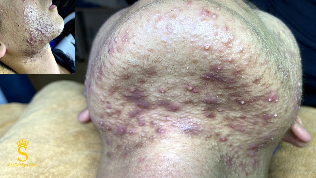 Make Your Acne Treatment Acne Spa 605 Acne Spa Treatment Youtube