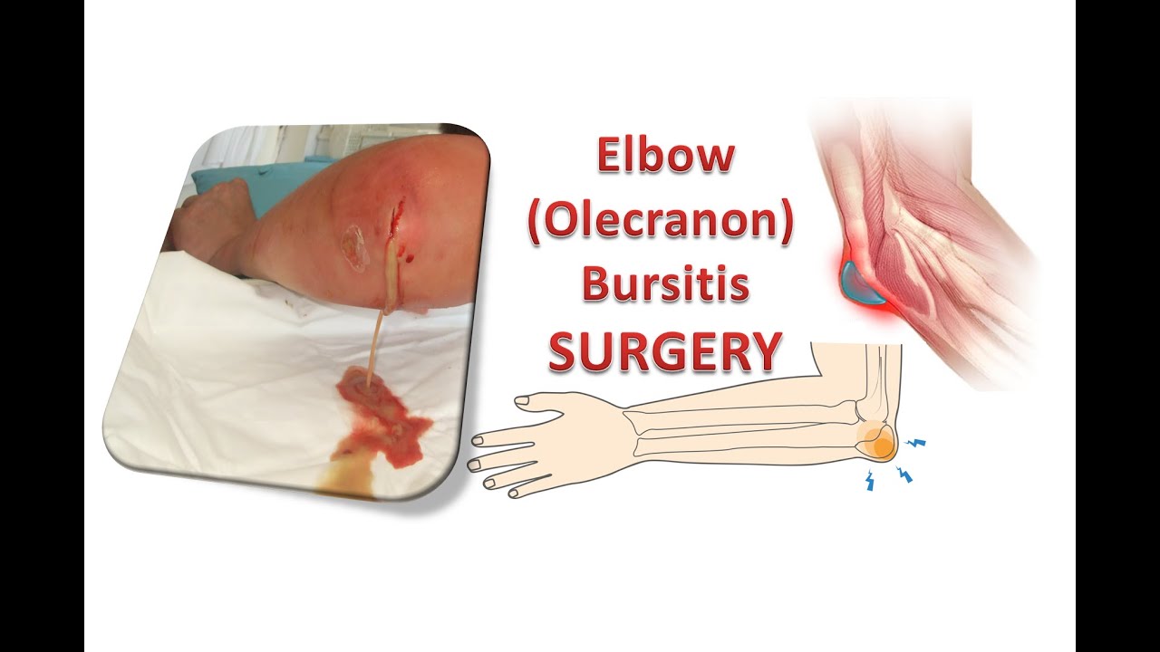 Elbow Bursitis Treatment Olecranon Bursitis Surgery локтевой