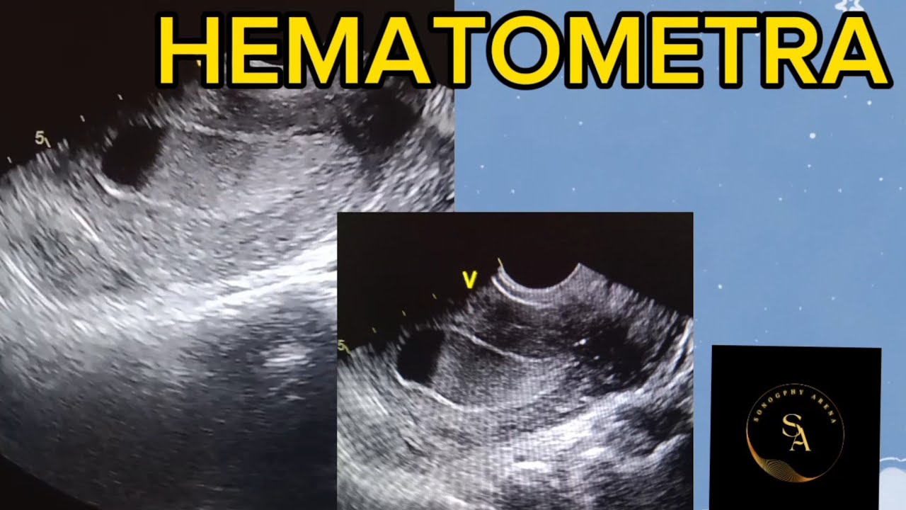 Hematometra A Detailed Ultrasound Case Study Youtube