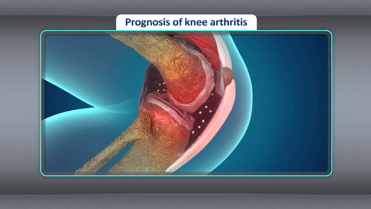 Xrays Forecast Progressive Knee Osteoarthritis
