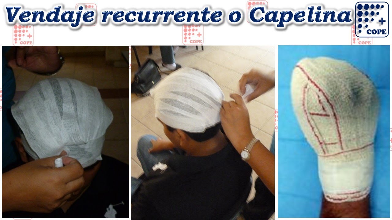 Diferentes Tipos De Vendaje De Capelina O Recurrente Youtube