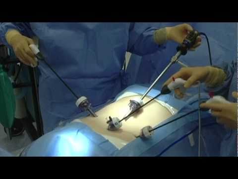 Laparascopic Hysterectomy Simulation Training Youtube