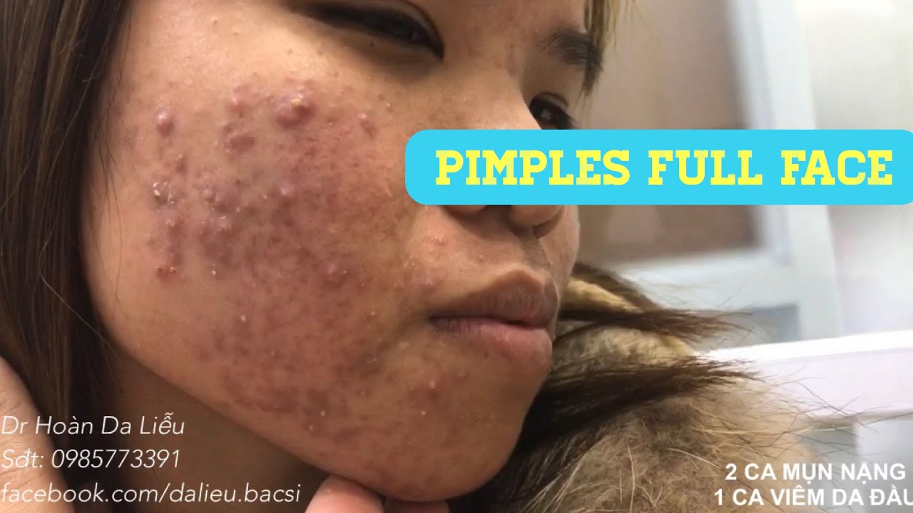 2 Ca Má N Trá Ng Cã Kem Trá N Dermatologist Treating Squeeze Big Pimples