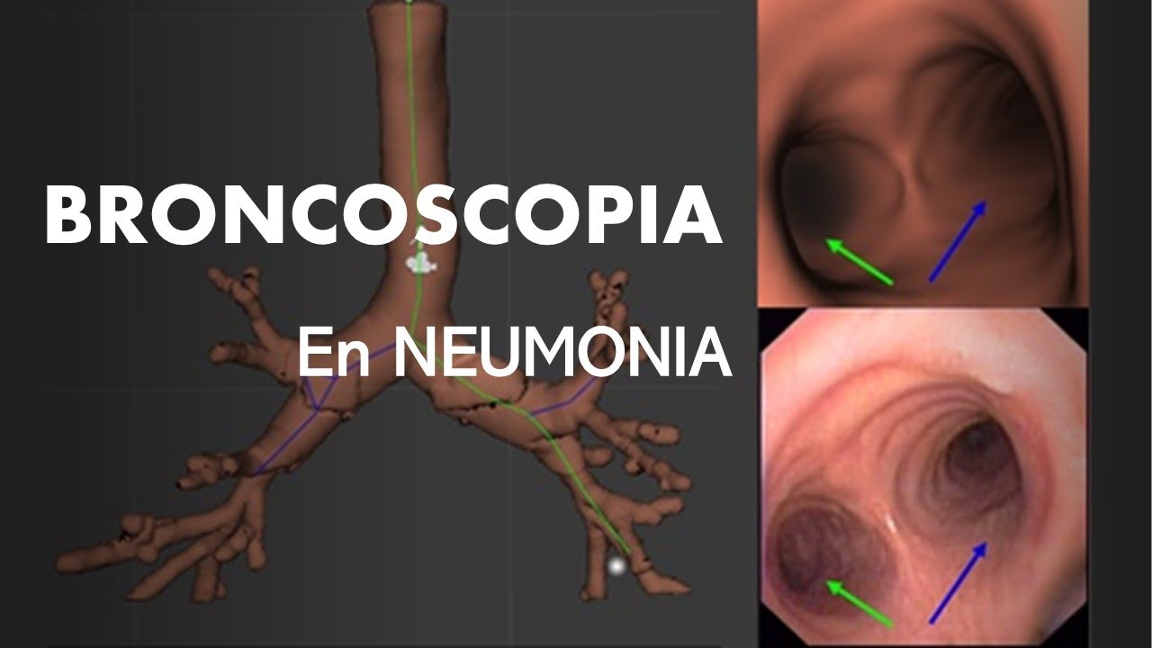Broncoscopia En Neumonía Youtube