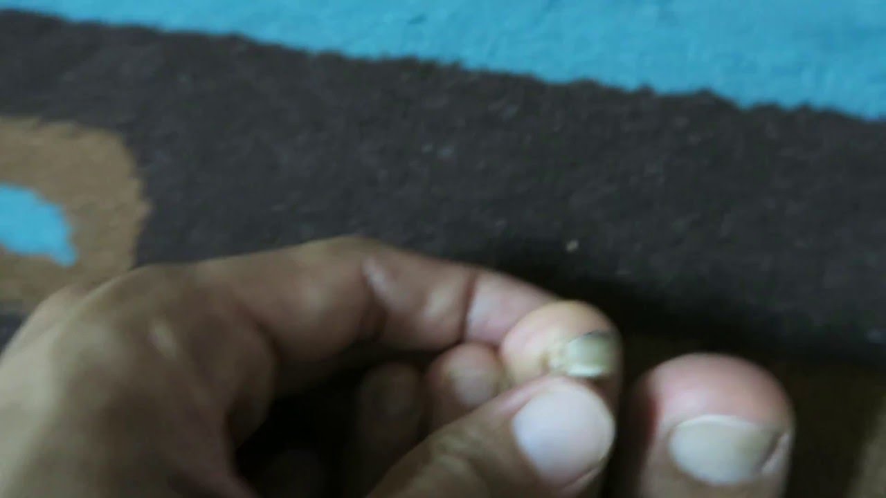 My Toe Nail Is Falling Off Youtube