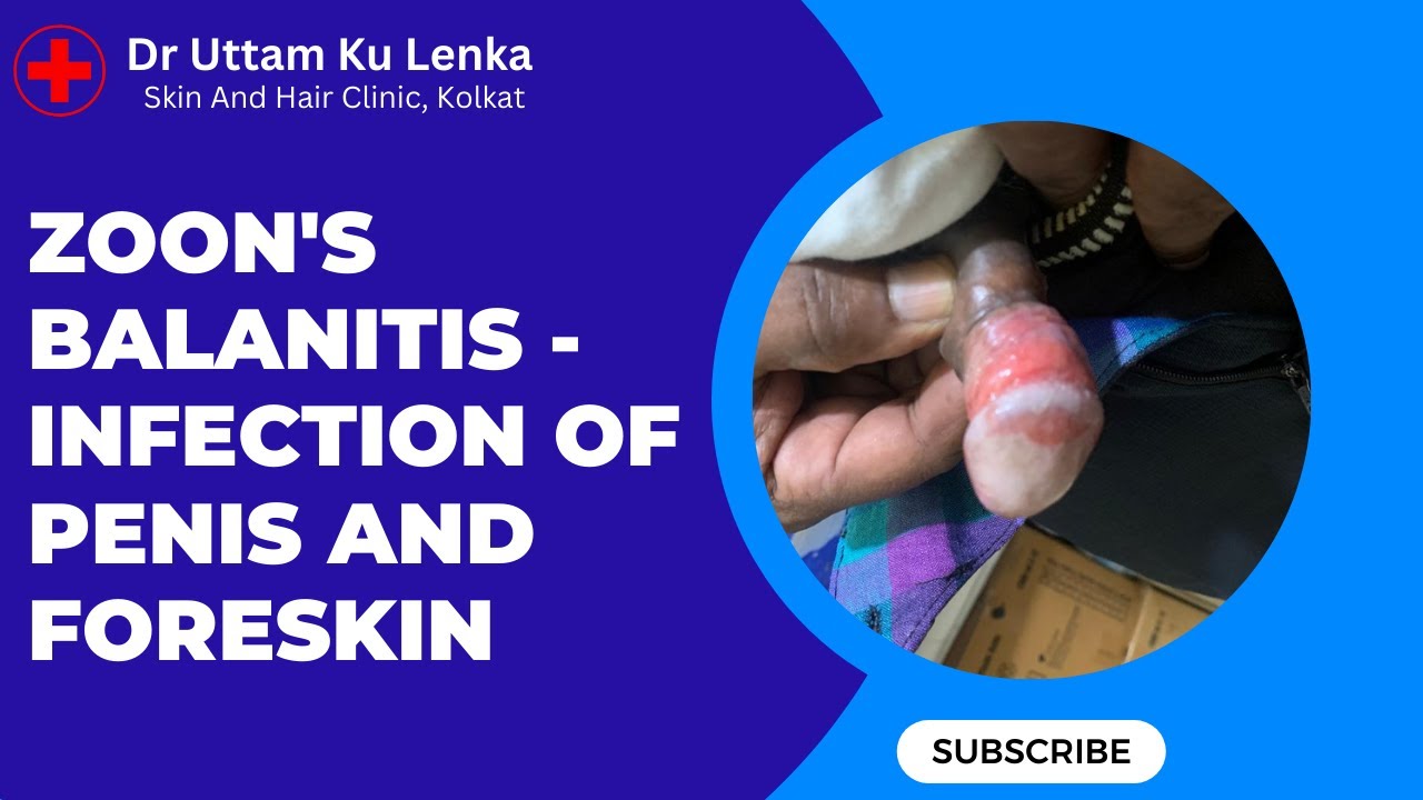 Red Rash And White Spots Under Foreskin At Mark Jennings Blog