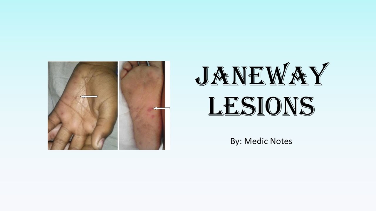 Janeway Lesions