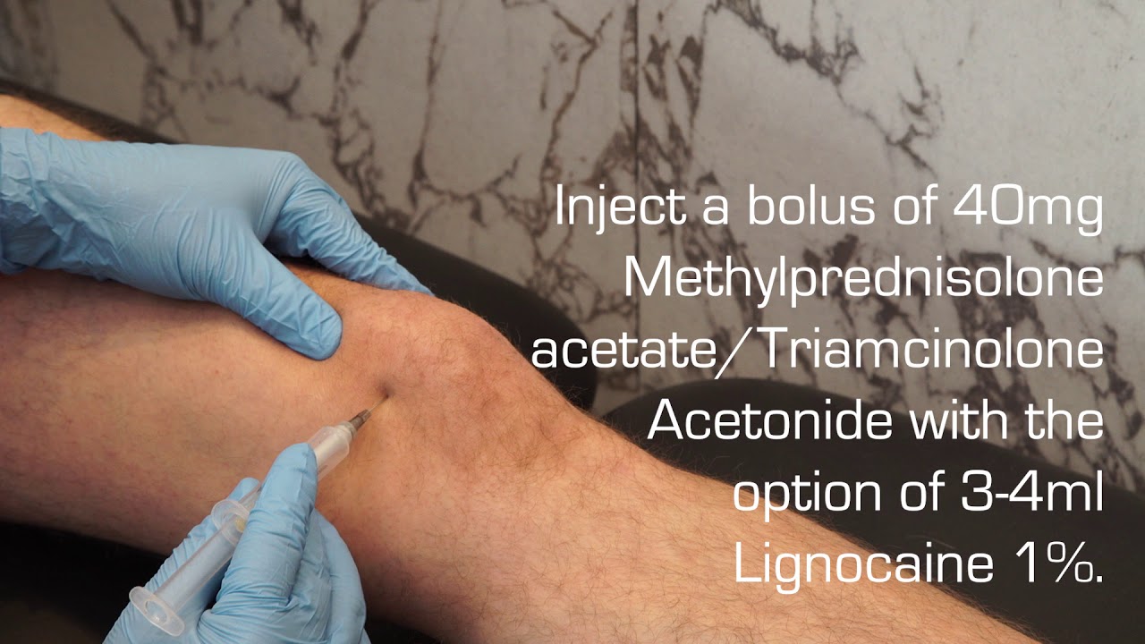 Injection Technique Into The Knee Joint For Oa Youtube