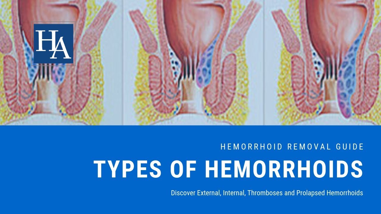 What Are Hemorrhoids Like Discover External Internal Thromboses And