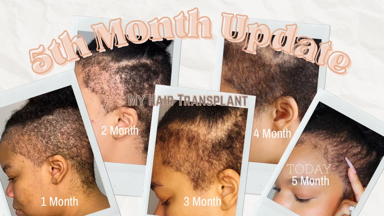 5 Months Hair Transplant Update Post Op 154 Longevita Youtube