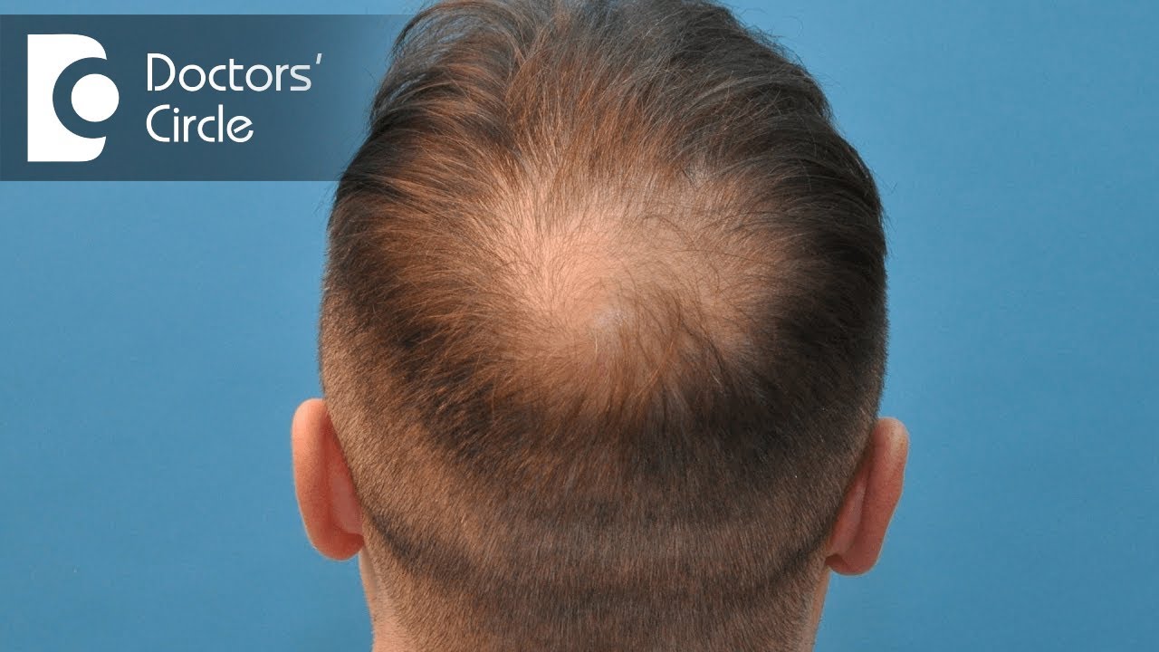 Best Haircut For Balding Crown 100 Of The Best Hairstyles For Balding