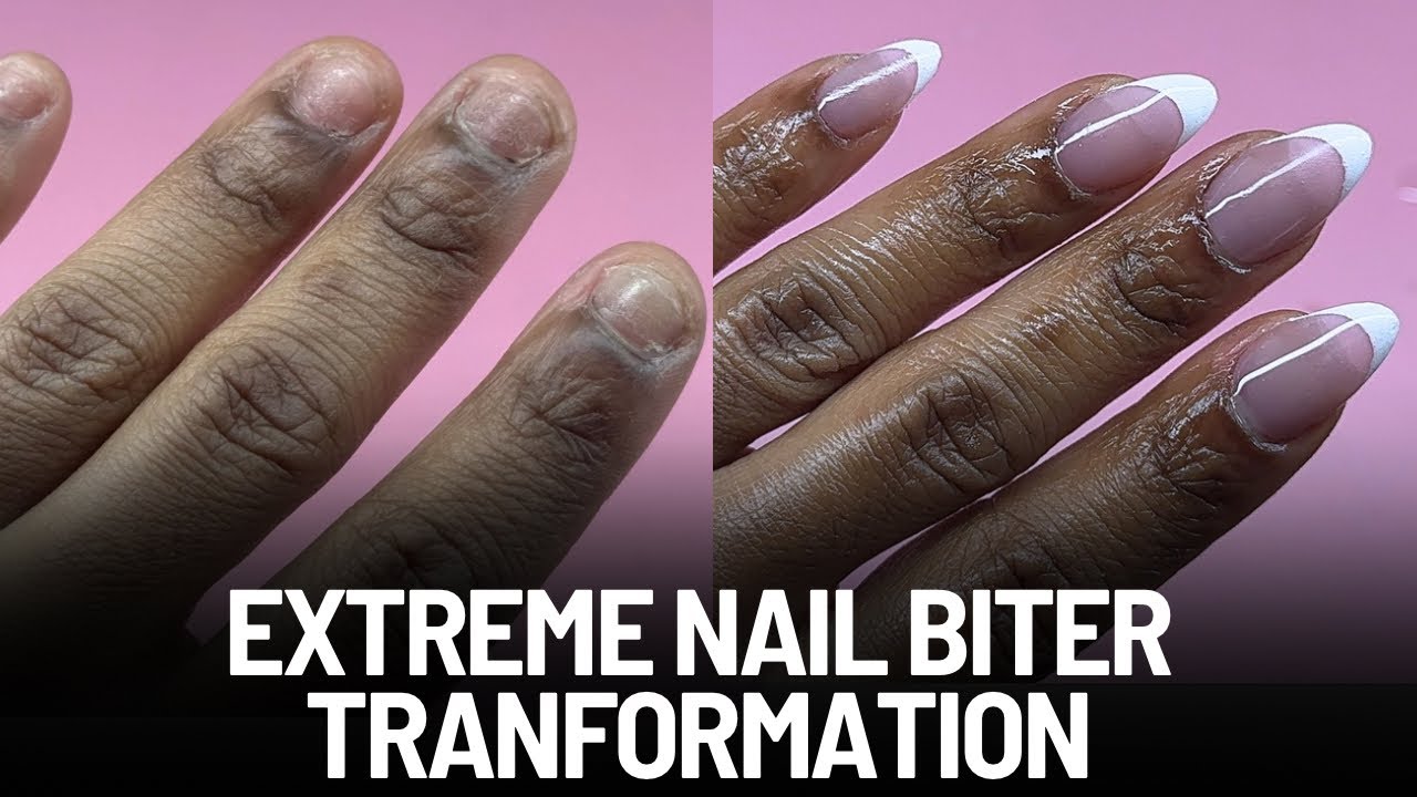 Nail Extensions On Bitten Nails Extreme Nail Biter Transformation