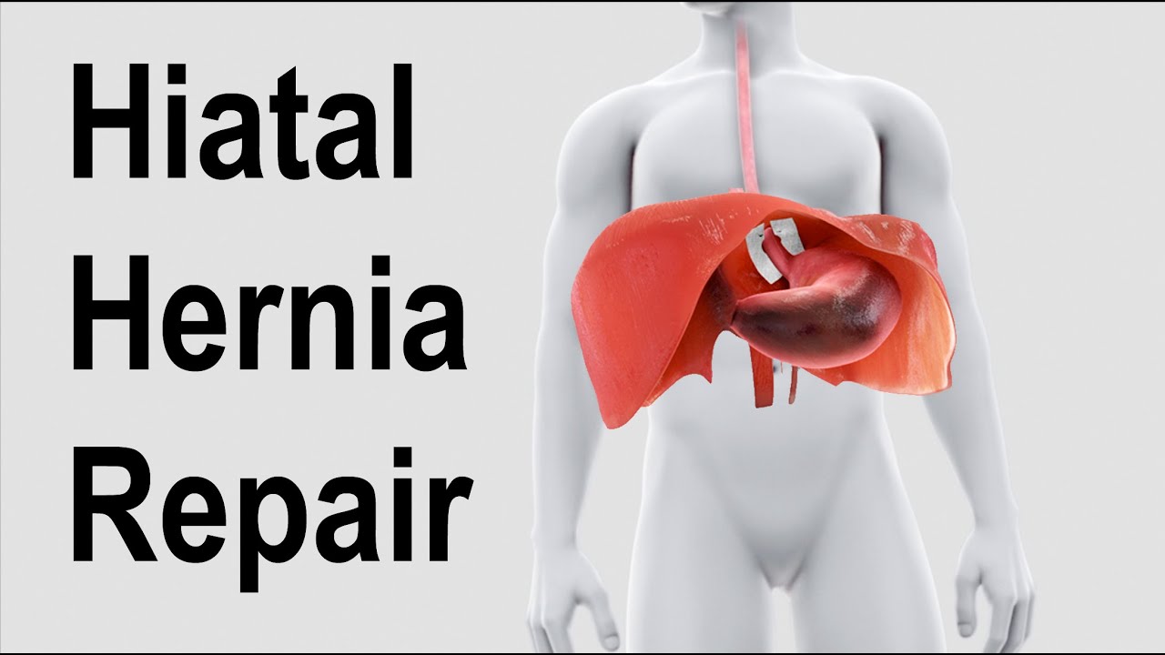 Hiatal Hernia Repair Animation Youtube