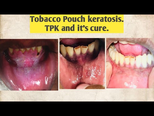 Tobacco Pouch Keratosis