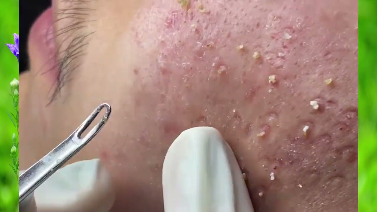 Pimple Popping Blackhead Removal At Angela Bates Blog