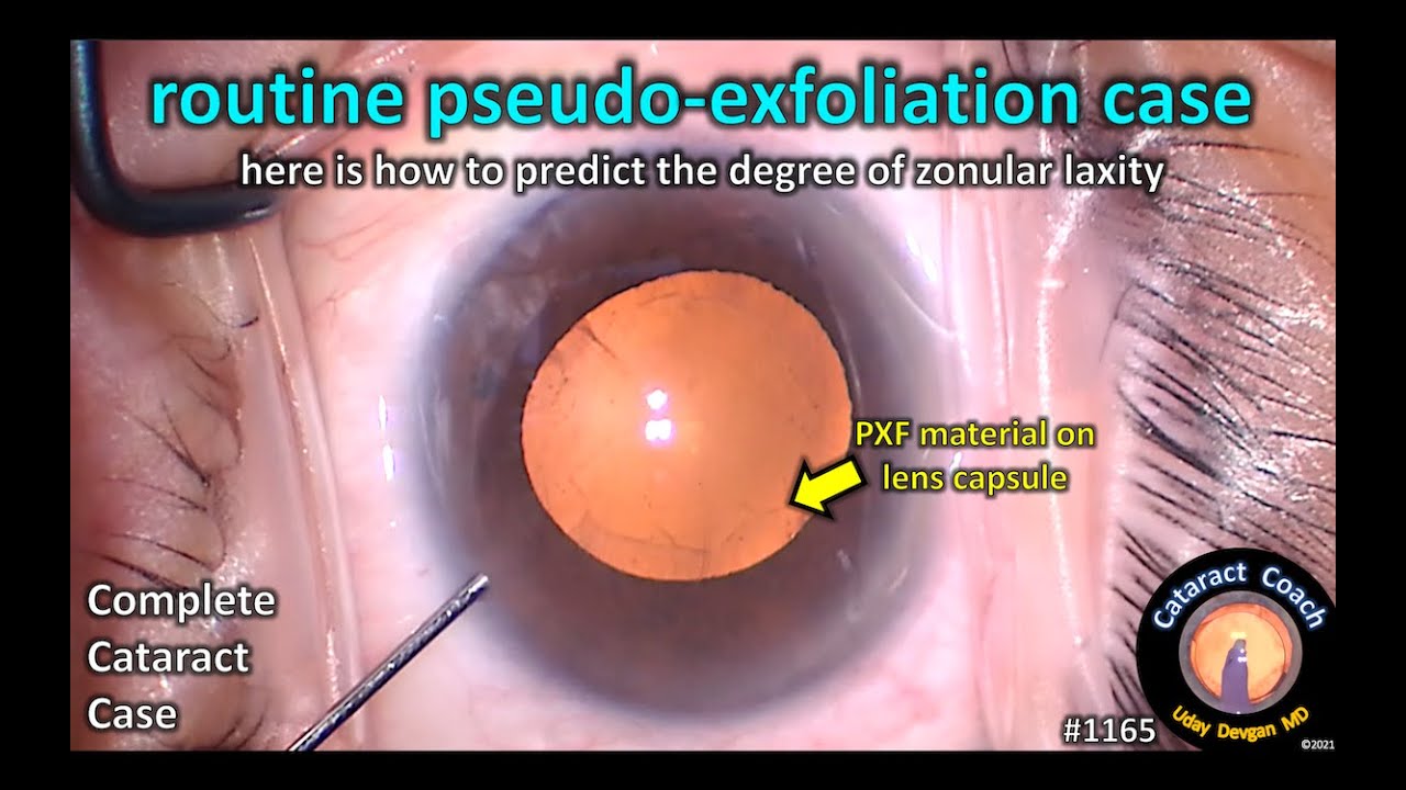 Cataract Surgery Eyes With Pseudoexfoliation Syndrome At Jonathan