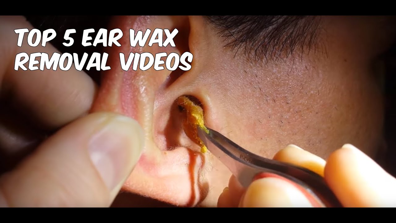 Cleaning Out Impacted Ear Wax