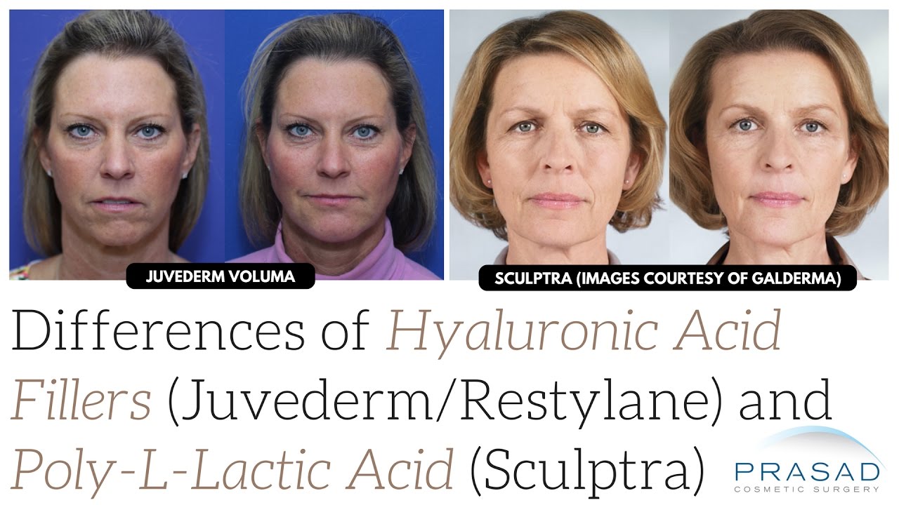 Differences Of Juvederm Voluma And Sculptra In Time Of Results