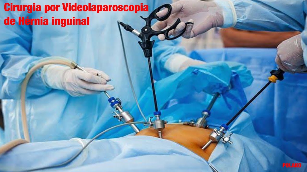 Minha Cirurgia Por Videolaparoscopia De Hérnia Inguinal Youtube