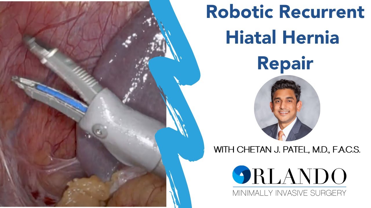 Robotic Recurrent Hiatal Hernia Repair Chetan J Patel M D Youtube