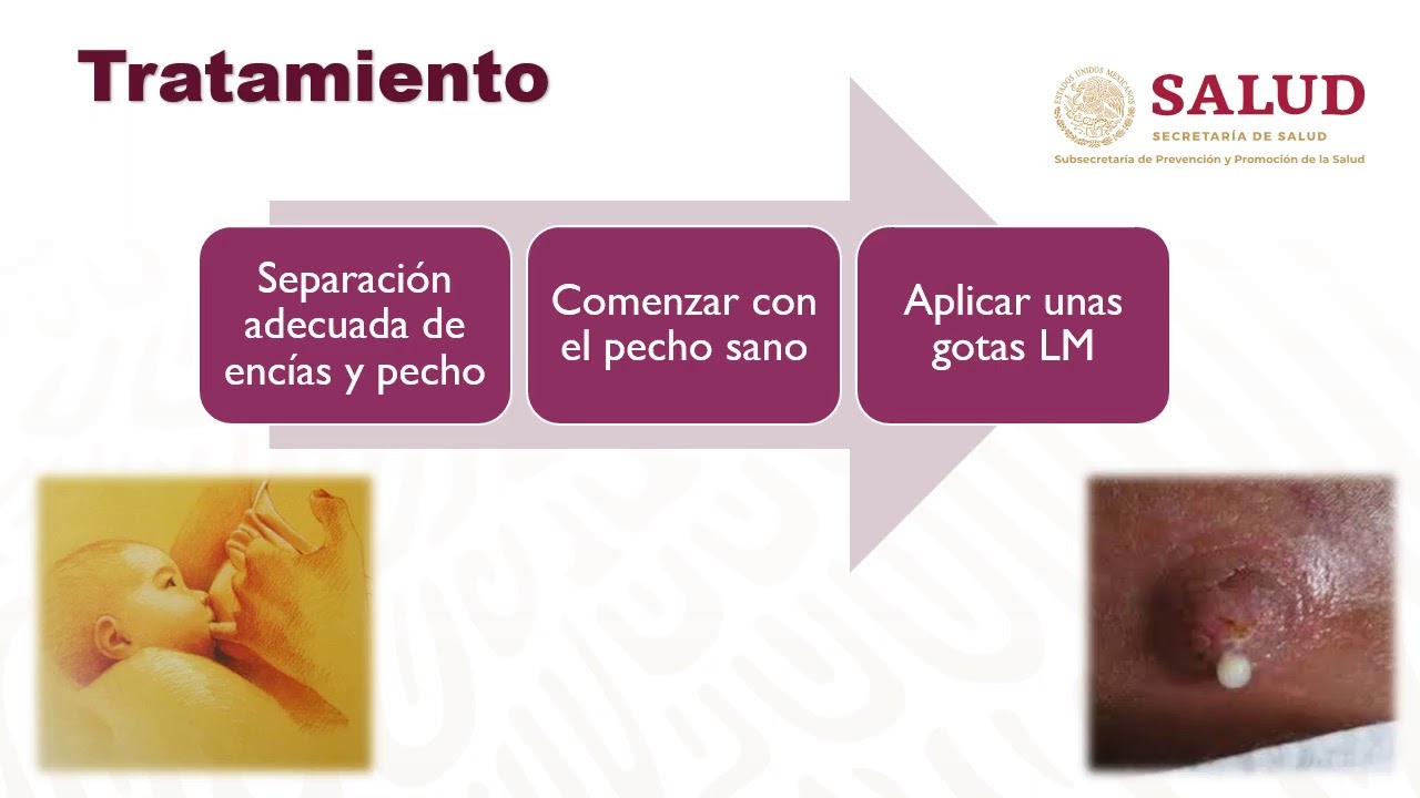 Pezón Doloroso Y Grietas Del Pezón Youtube
