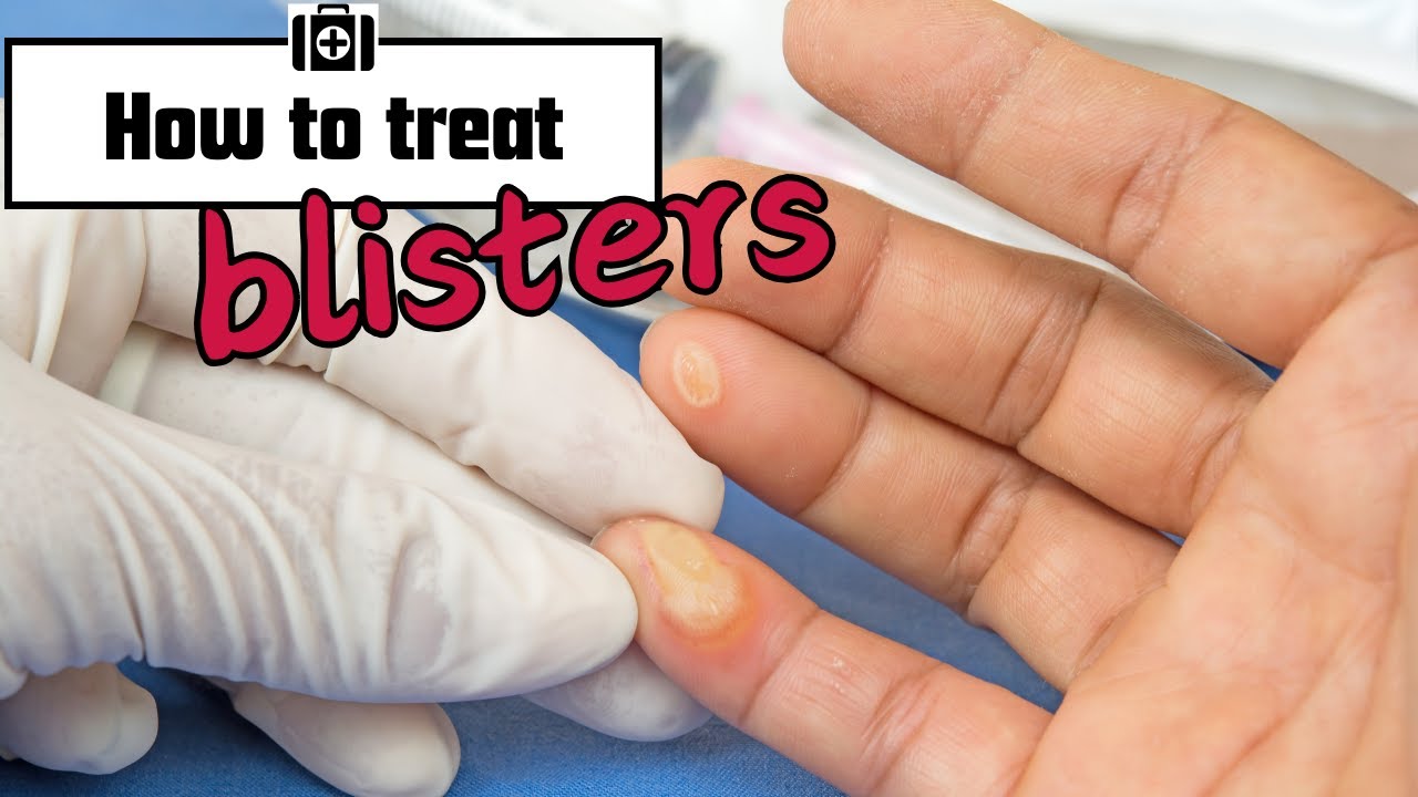 How To Prevent And Treat Blisters Simple Tips For Fast Recovery Youtube