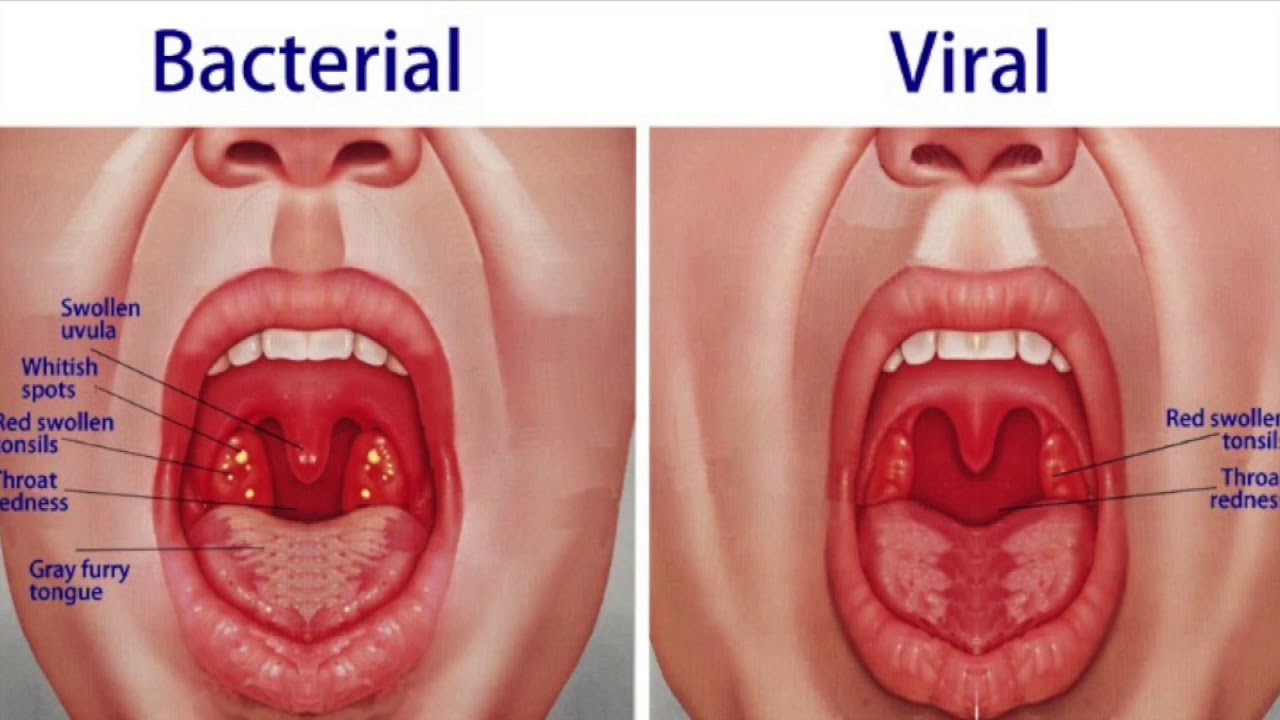 Cómo Diferenciar Una Faringitis Viral Y Bacteriana Iqdw