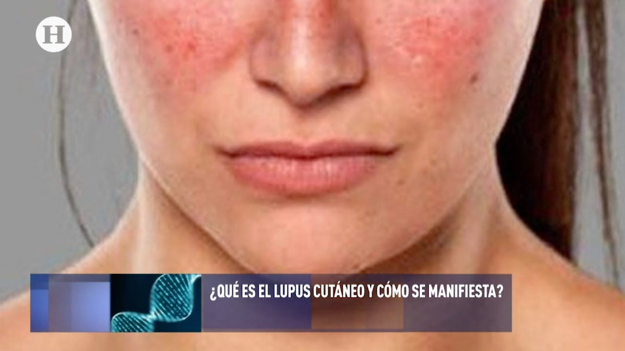 Qué Es Y Cómo Se Manifiesta El Lupus Cutáneo Youtube