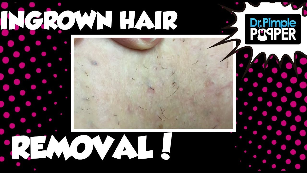 Ingrown Hair Removal Youtube