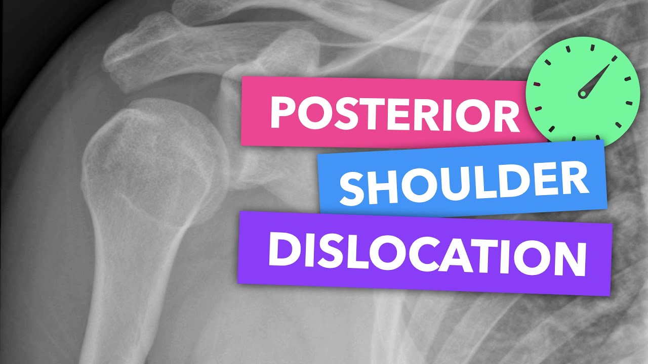 Posterior Shoulder Dislocation Radiopaedia Emergency Radiology Course