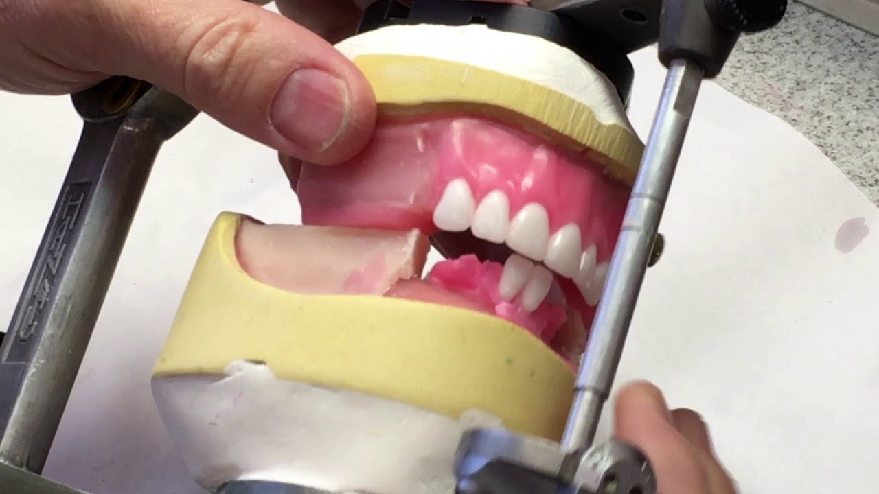 Mandibular Anterior Setup Youtube