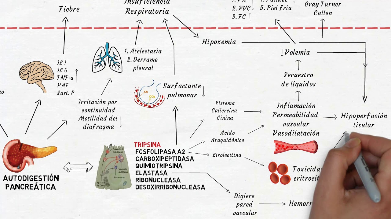 Fisiopatología De La Pancreatitis Aguda En 6 Minutos Youtube