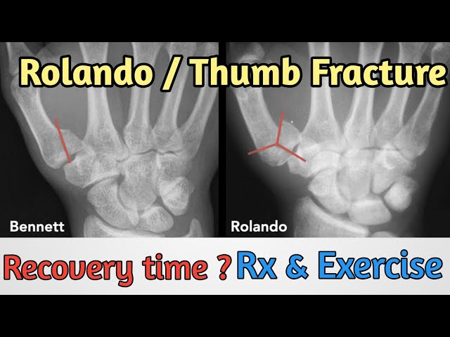 Rolando Vs Bennett Fracture 29 Hand Fractures And Dislocation