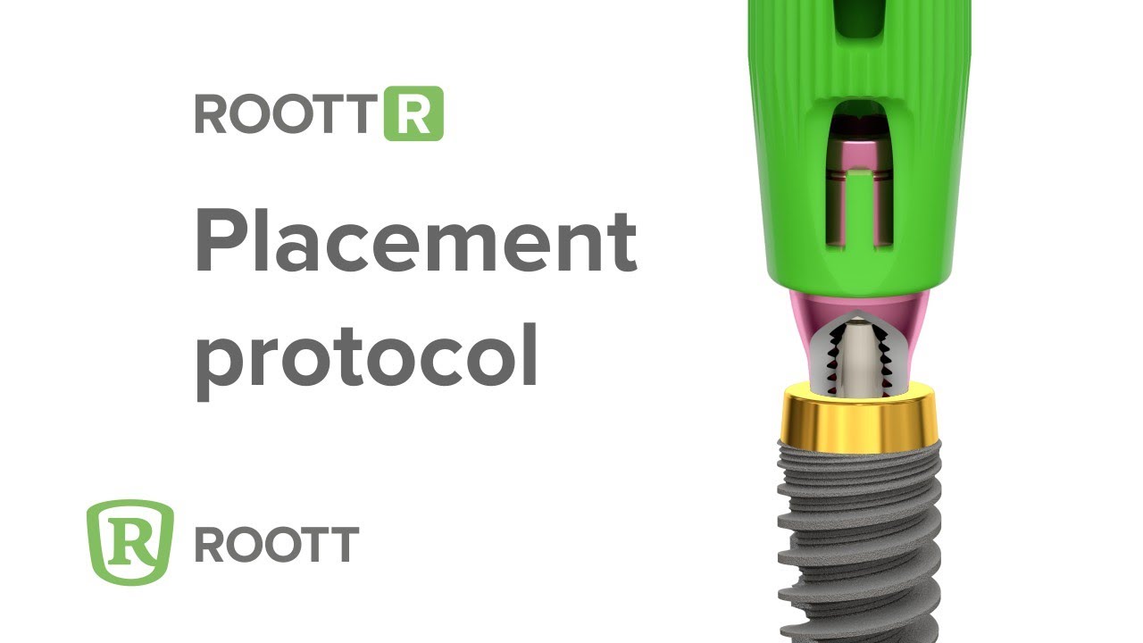Roott R Placement Protocol Youtube