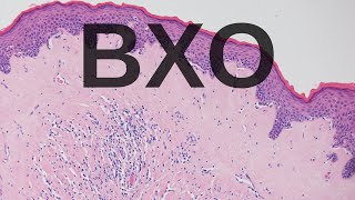 Balanitis Xerotica Obliterans Bxo Pathology Mini Tutorial Pathology ...