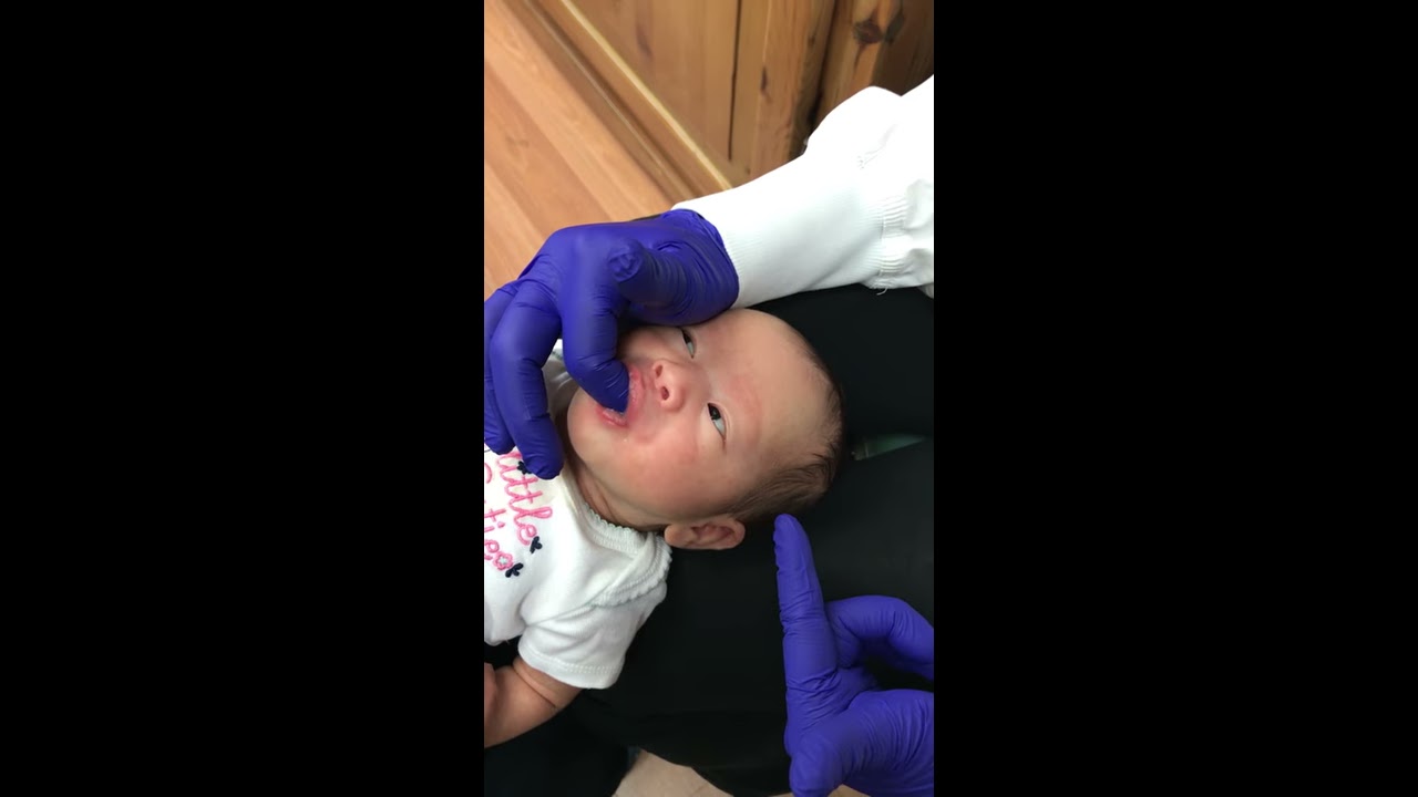 Tongue Tie Stretches A Parent S Guide To Post Frenotomy Care