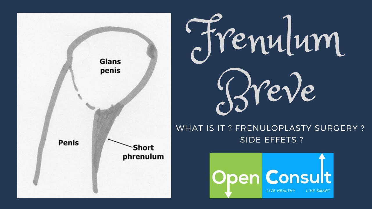 Frenulum Breve Stretching