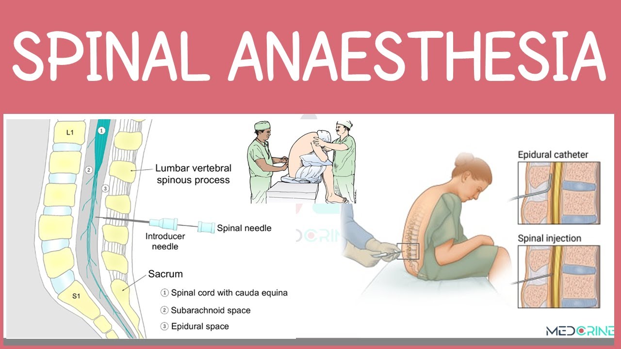 Spinal Anesthesia Procedure Technique Drugs Indications And