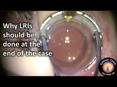 This Is Why I Do Lris Limbal Relaxing Incisions At The End Of The